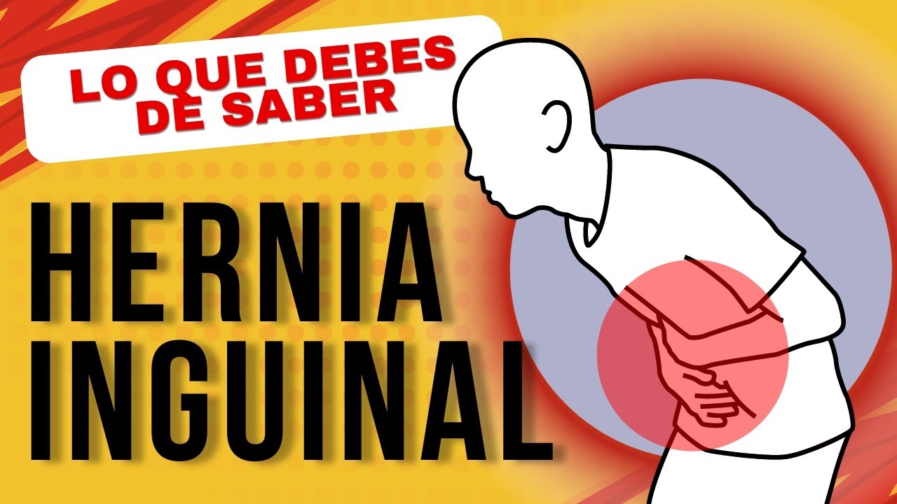 HERNIA INGUINAL (DIRECTA E INDIRECTA) Y CRURAL | TRIANGULO DE ...