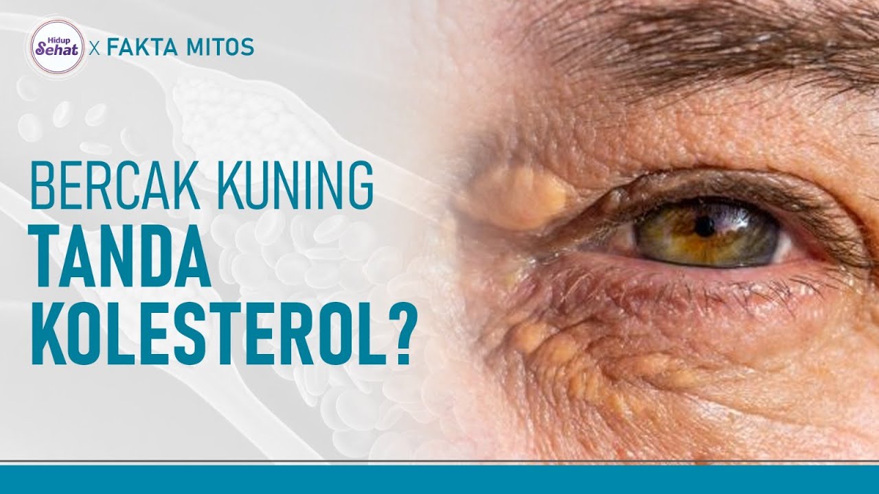 Benarkah Bercak Kuning di Sekitar Mata Tanda Kolesterol Tinggi? | Hidup ...