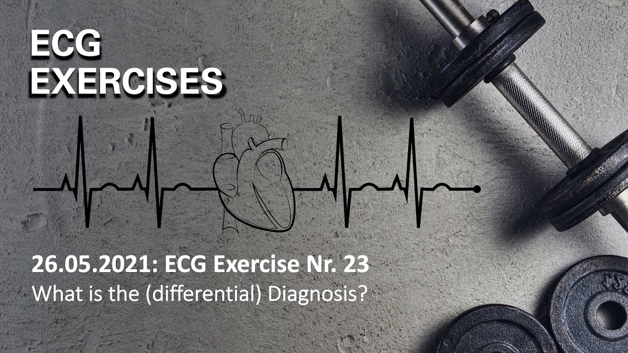 ECG Exercise 23: a 45 year old woman with recurrent PVC induced VF ...