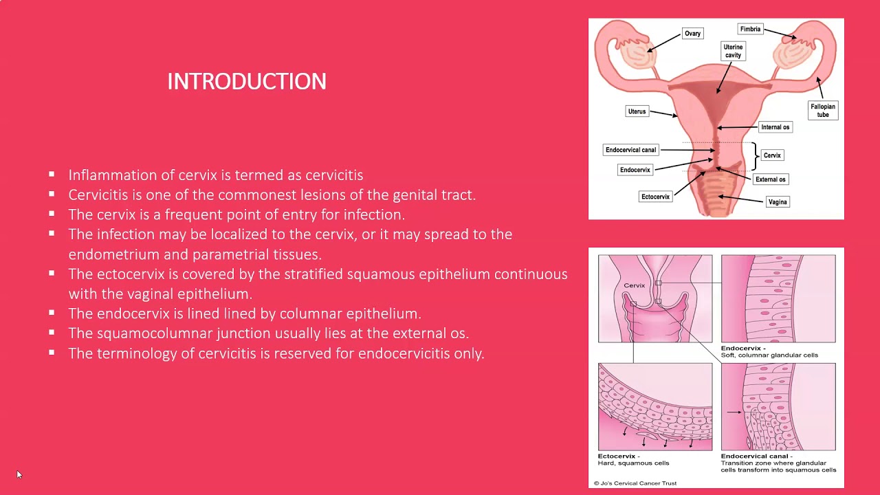 Acute Cervicitis part 1 by Nadia Naseem - YouTube