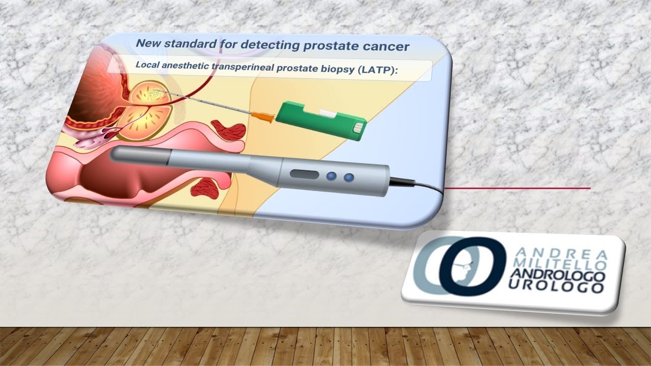 Come viene eseguita la biopsia prostatica e quali sono le varie ...