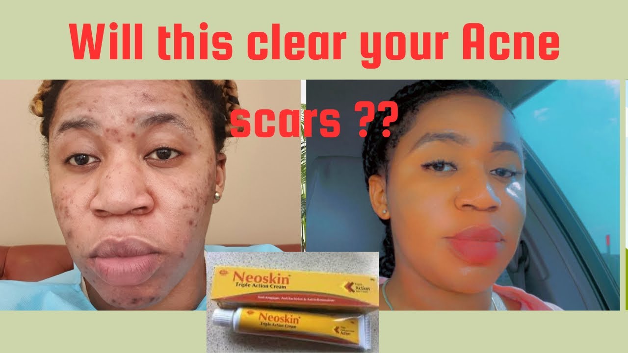 Watch this video till the end before using Neoskin cream (tube) for ...