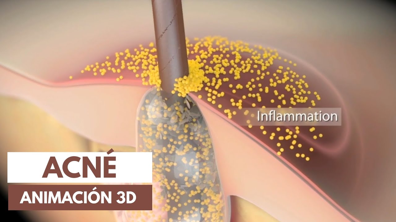 Tratamiento del acné | Animación 3D - YouTube