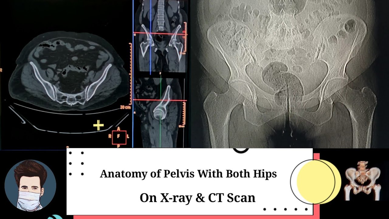 Anatomy of Pelvis With Both Hips | X-ray & CT scan | By Anis Qureshi ...