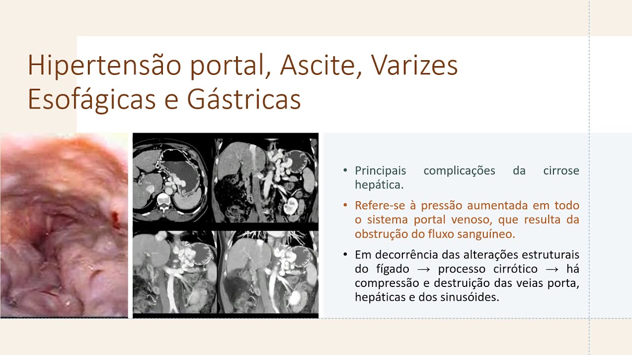 Hipertensão Portal, Ascite, Varizes Esofágicas e - YouTube