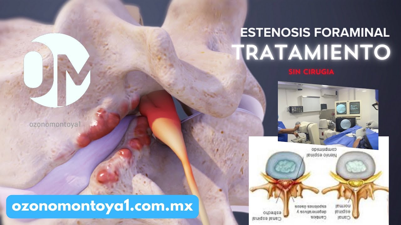 Tratamiento de canal estrecho,listesis y hernias lumbares múltiples ...
