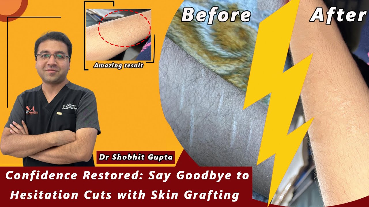 Confidence Restored: Say Goodbye to Hesitation Cuts with Skin Grafting ...