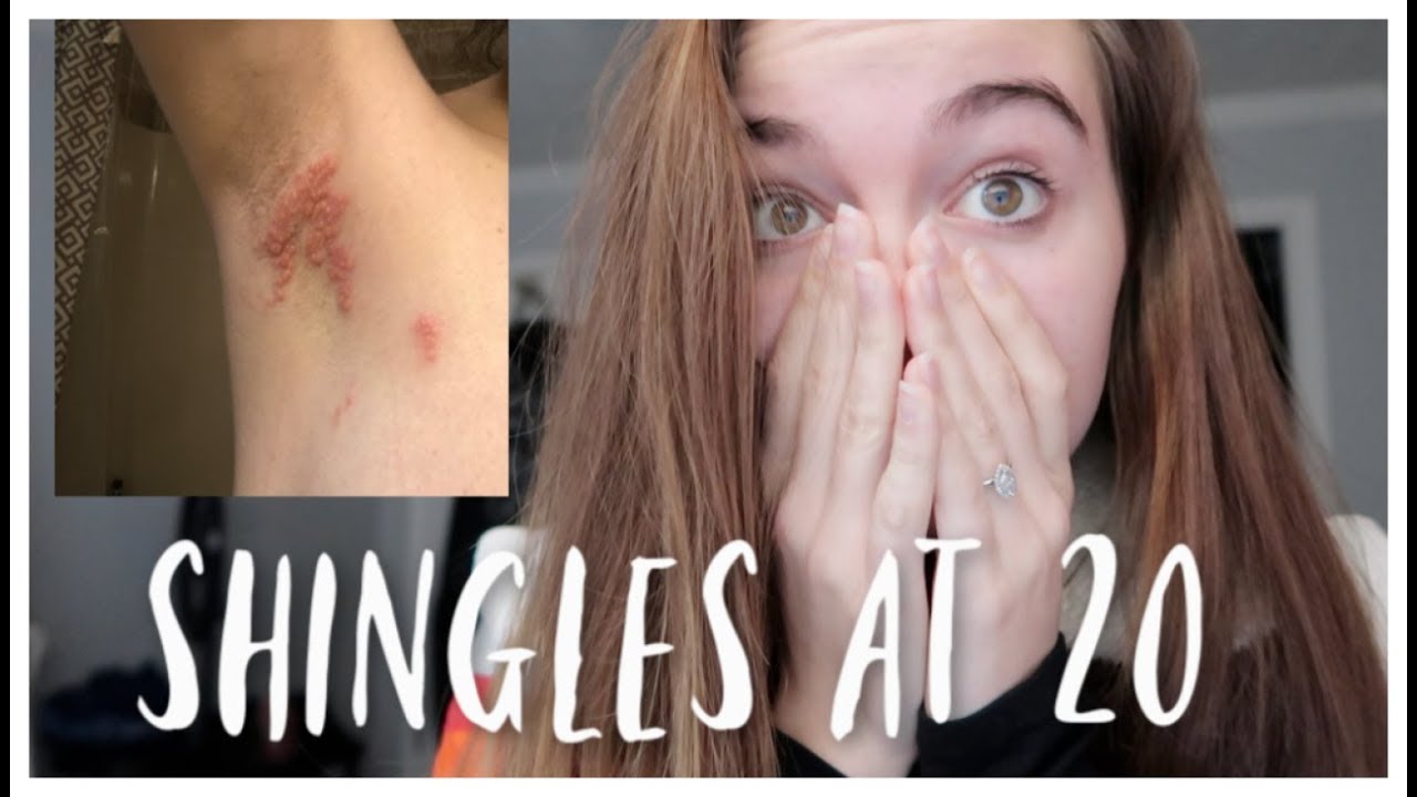 Getting Shingles At 20 Years Old - YouTube