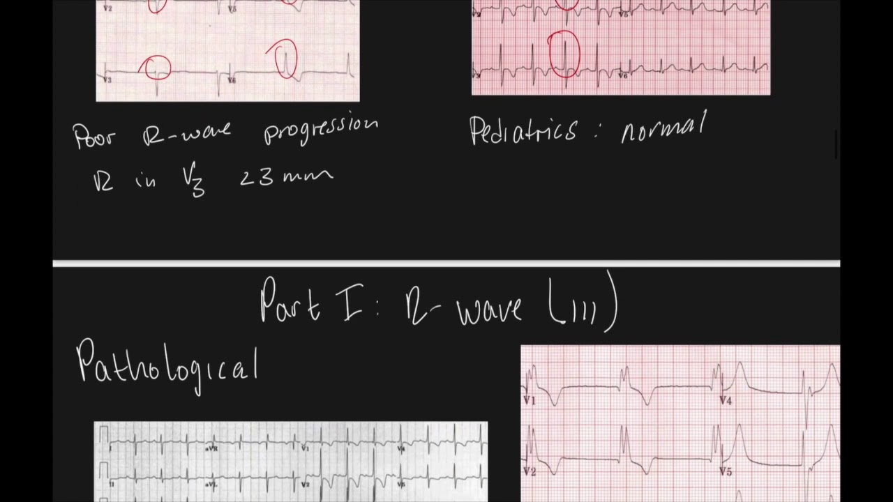 EKG Video Two: Variants and Pathologies - YouTube