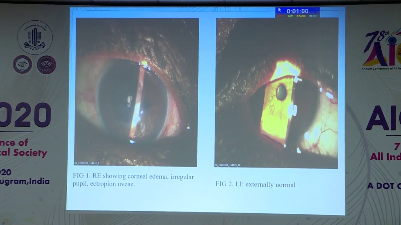 AIOC2020 HydePark I Dr Rahul Prasad Progressive Iris Atrophy rare ...