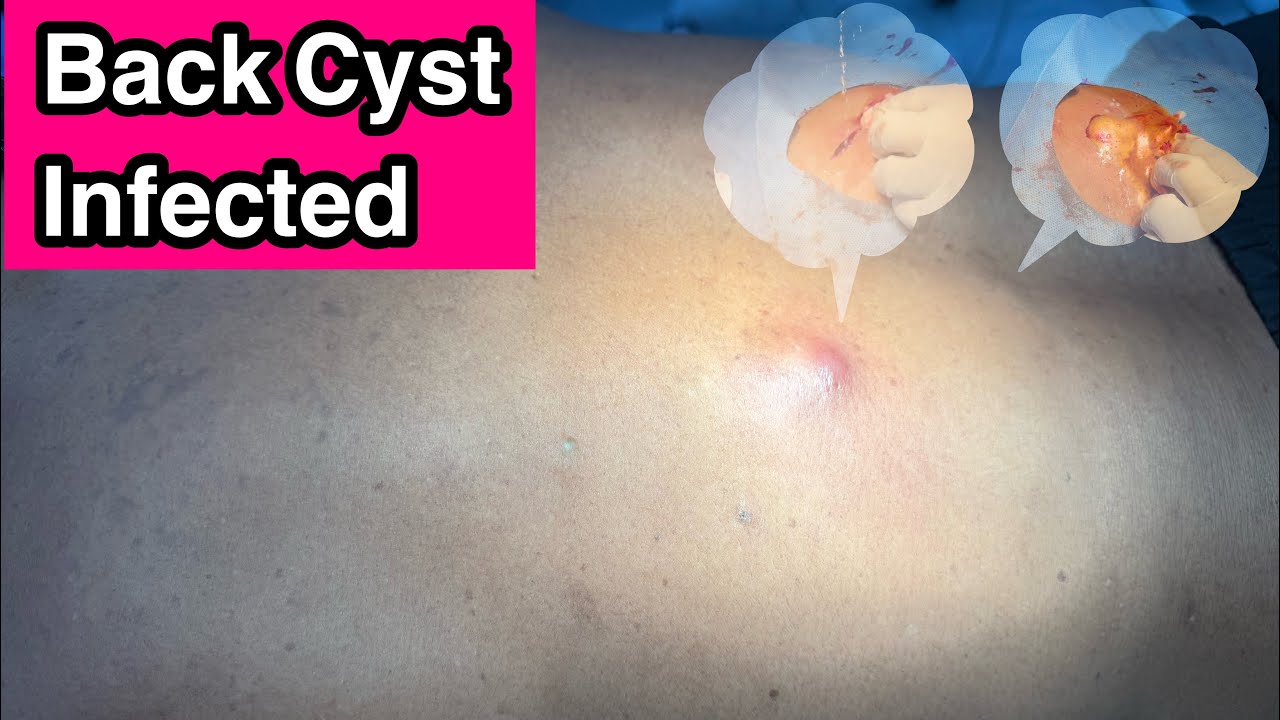 Back Cyst Infected #3 (Sebaceous Cyst Burst) 💥 - YouTube