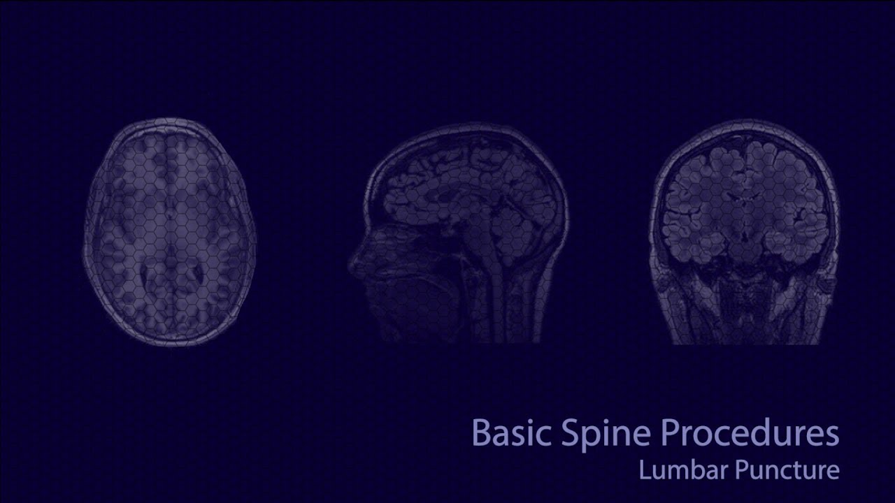 Basic neuroradiology procedures part 2 - Lumbar puncture - YouTube