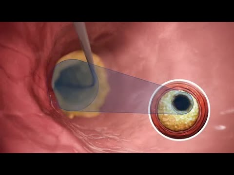 Debulking calcium with Hawkone™ directional atherectomy - YouTube
