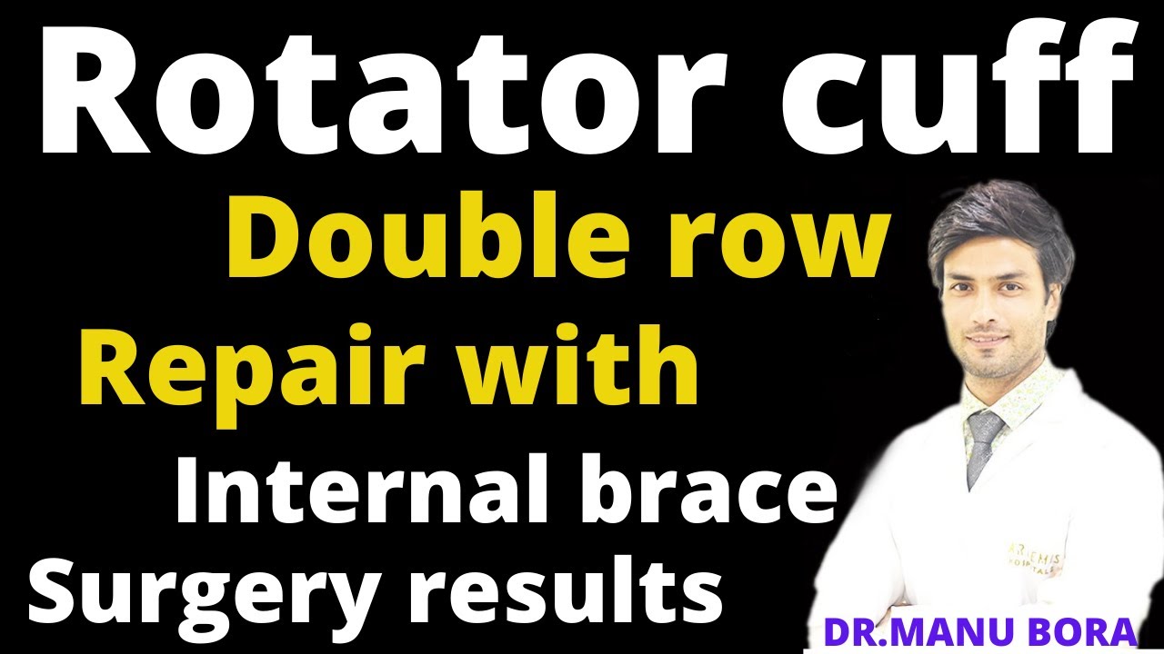 Rotator cuff double row repair with internal brace surgery results, DR ...