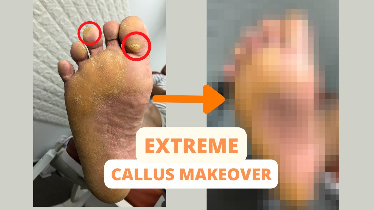 EXTREME Callus Makeover! - YouTube