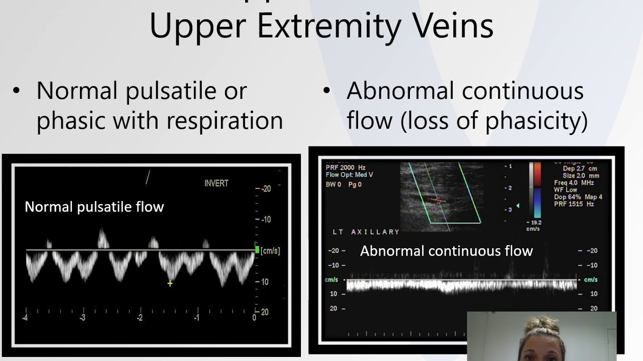 Technical Tip Tuesday Case Study - Upper Extremity Venous Thrombosis ...