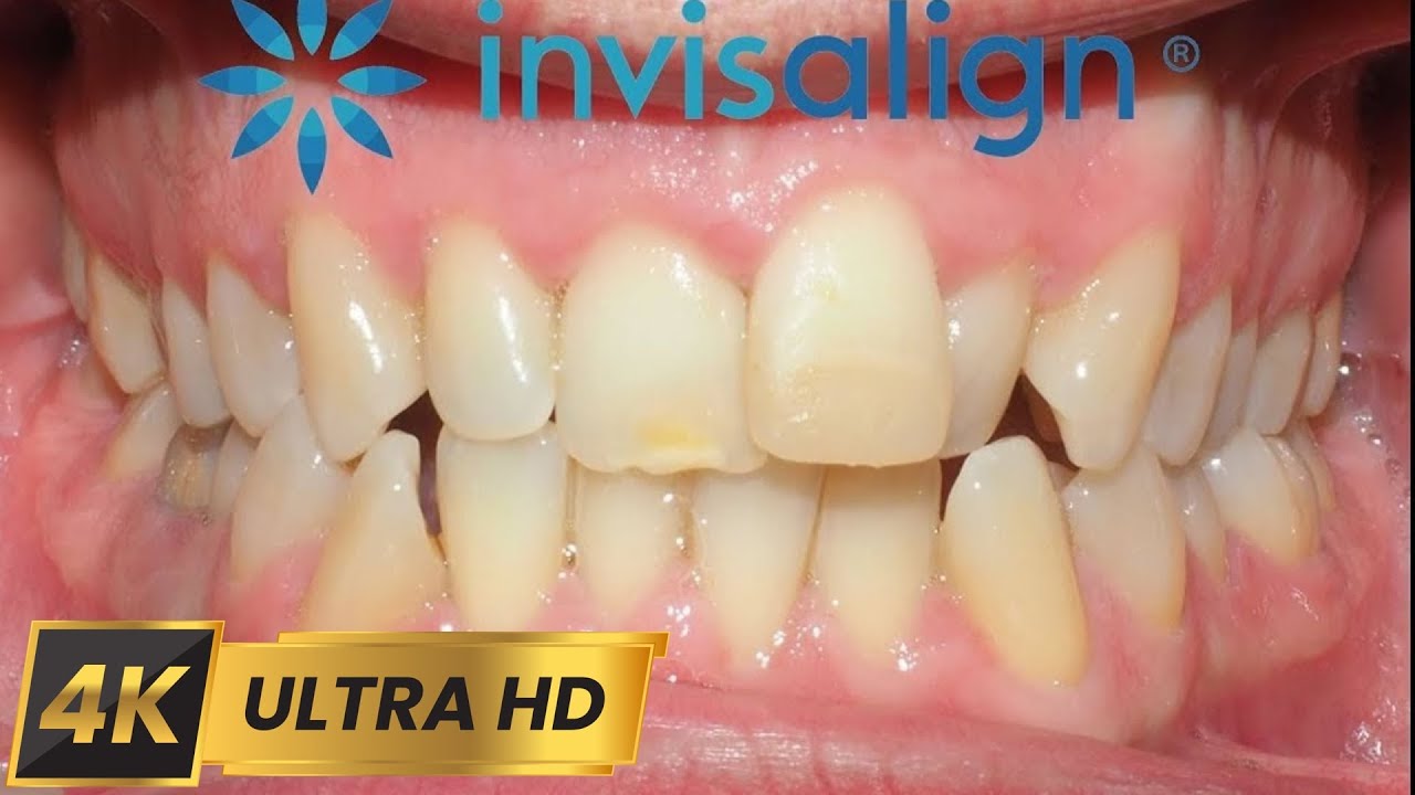 INVISALIGN treatment for 10 MONTHS! 4k time-lapse. - YouTube