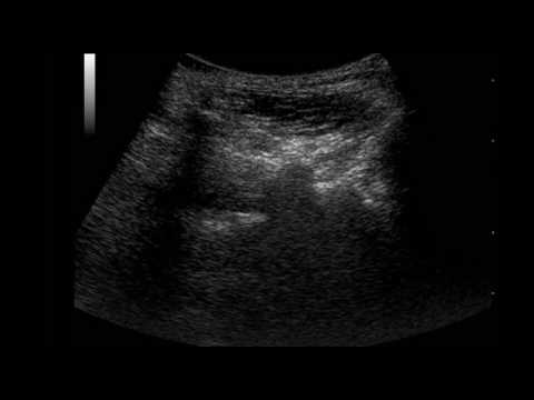 prolotherapy of low back under ultrasound guidance by Dr Harry Adelson ...