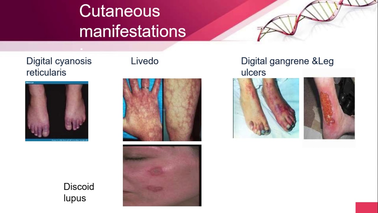 lecture 7B (anti phospholipid syndrome - YouTube