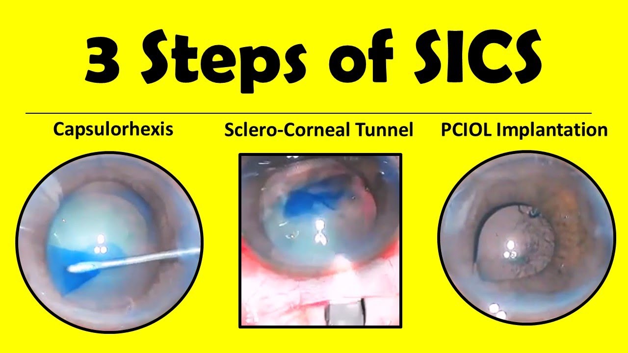 MSICS (Dr.Rakesh Koli) // 3 Steps // CCC // Tunnel // PCIOL // Resident ...