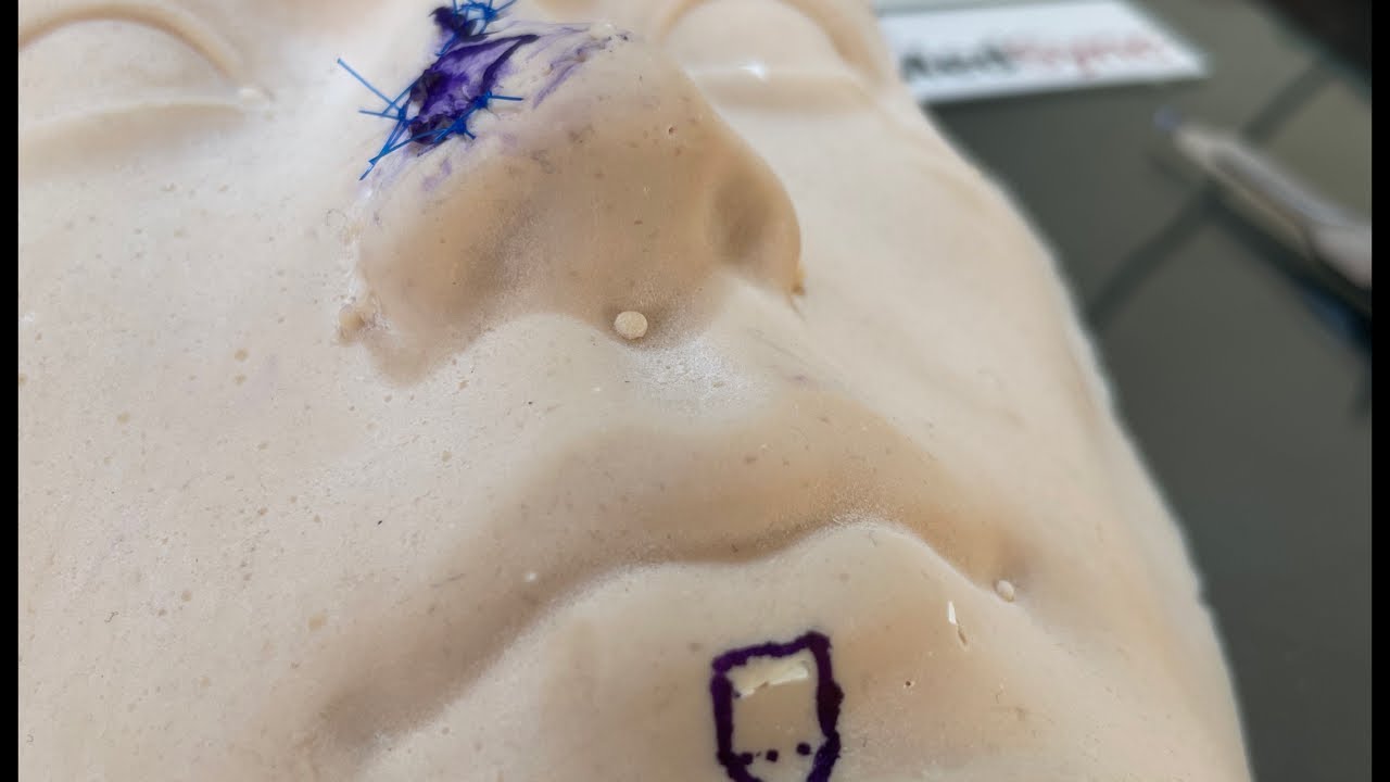 Local flaps on the face: The Rhomboid flap - YouTube