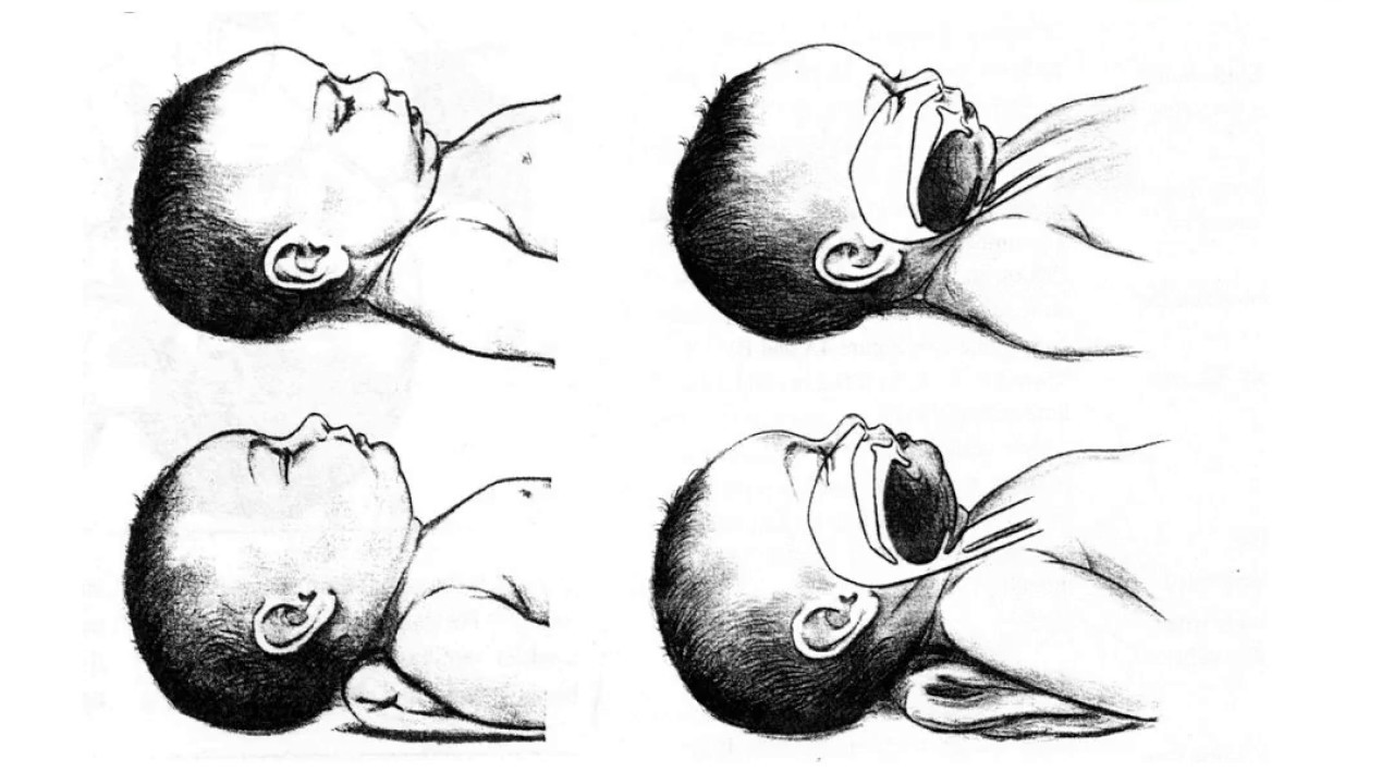 Prise en charge des voies aériennes chez l’enfant - YouTube