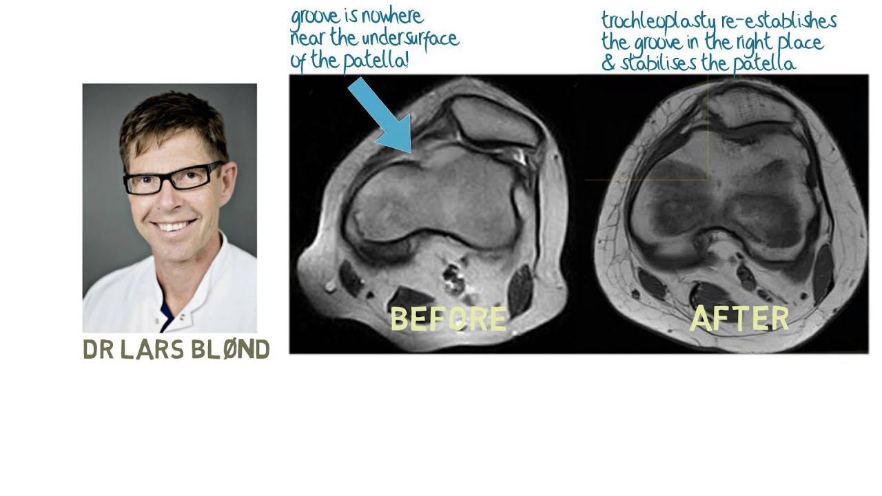 Arthroscopic Deepening Trochleoplasty - YouTube