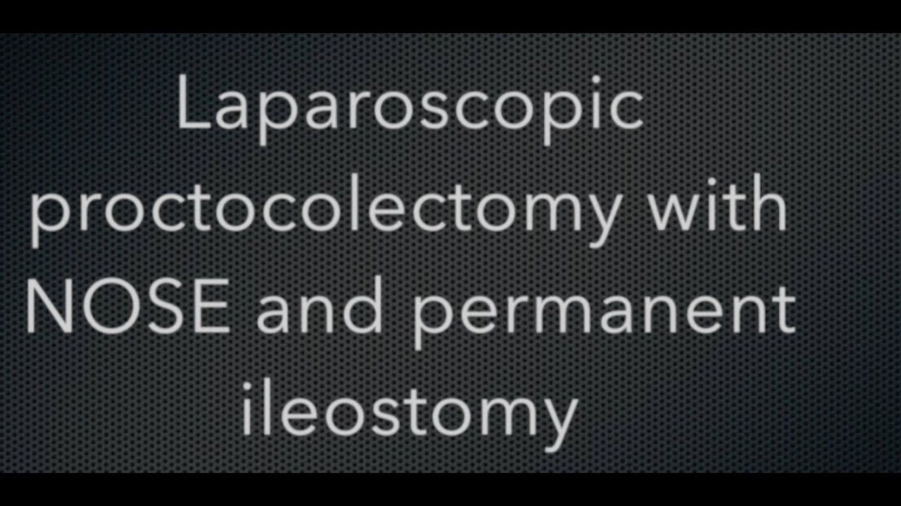 Lap D2 proctocolectomy with NOSE and terminal ileostomy - YouTube