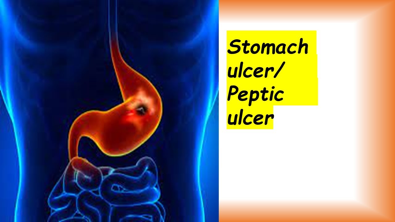 Stomach ulcer/ Peptic ulcer - YouTube
