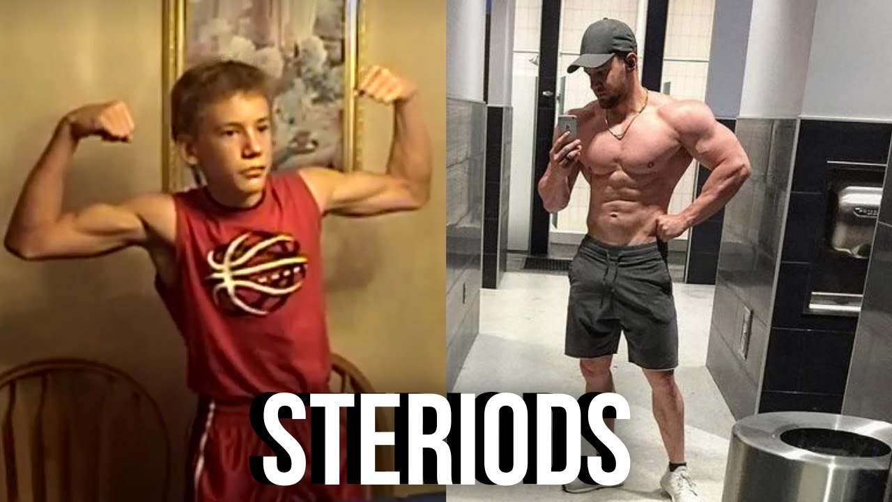 My 2 Year Steriod Transformation???? | My Story - YouTube