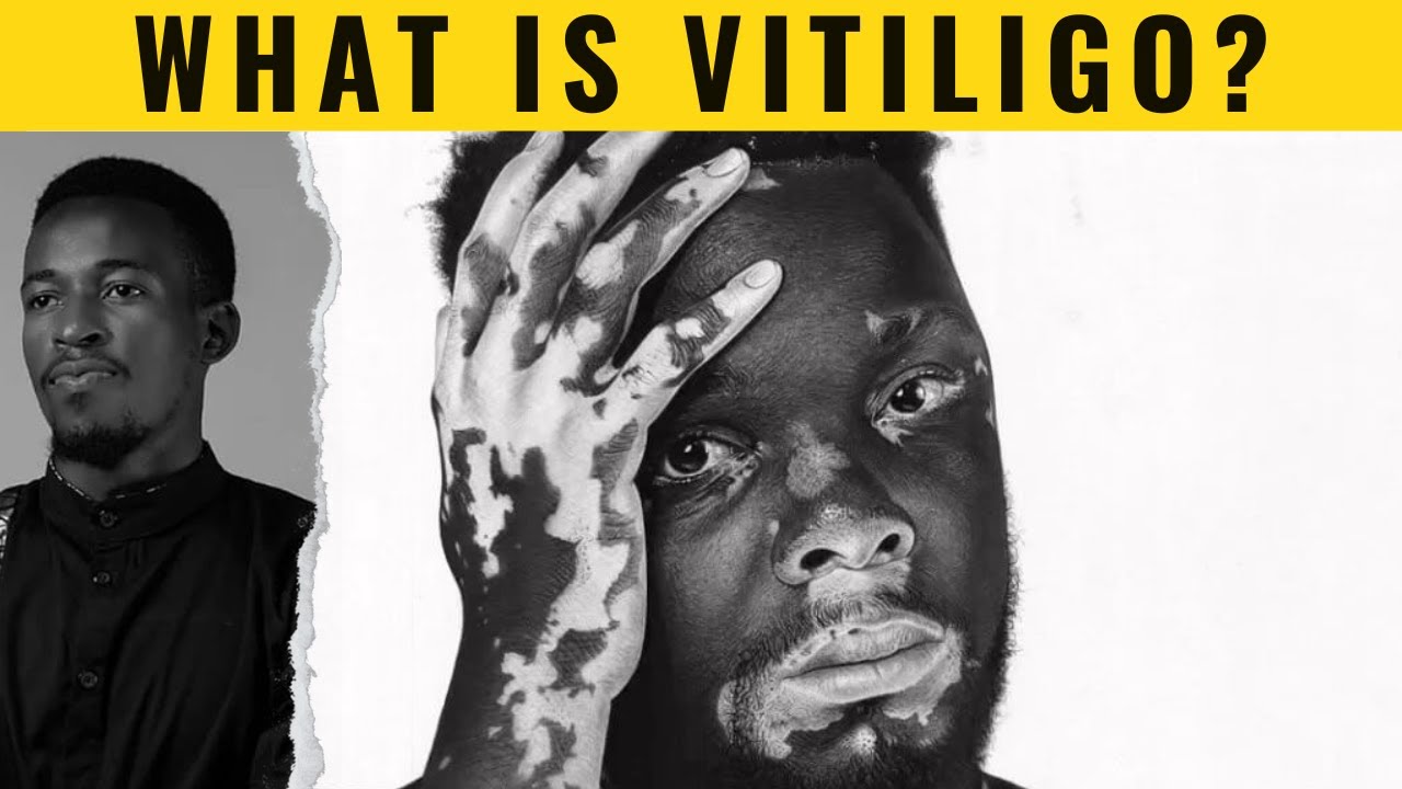 “What is Vitiligo, I help people understand vitiligo through my art ...