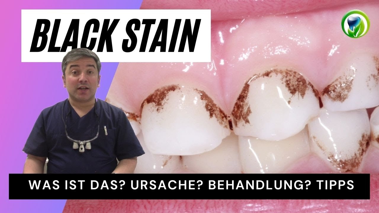 #BlackStain - Was ist das? Ursache? Gefährlich? Behandlung? Tipps - YouTube