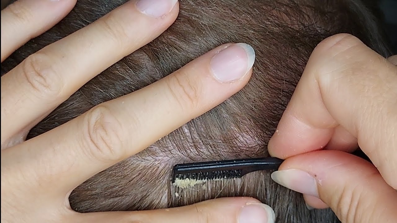 SCALP CHECK | Satisfying Dandruff / Scalp Build-Up REMOVAL | Real ...