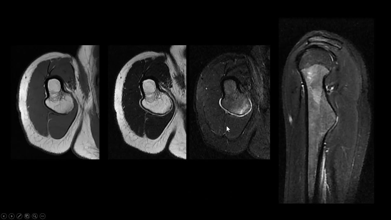 Osteocondroma - YouTube