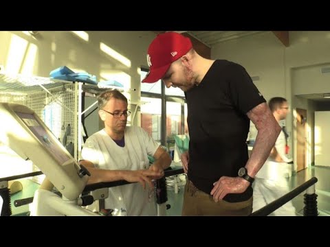 Burn victim saved by skin grafts from identical twin - YouTube