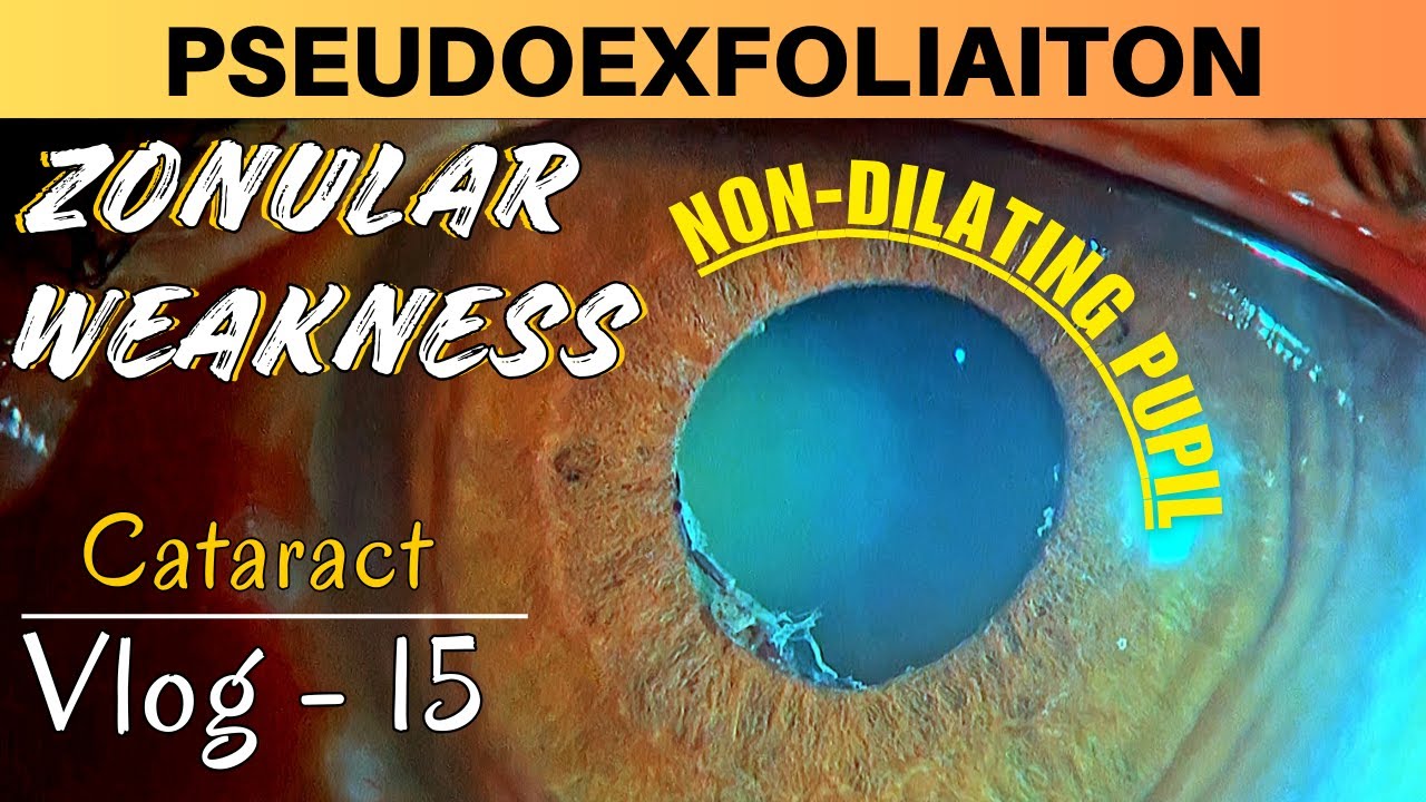 Small pupil Phacoemulsification.Pseudoexfoliation, BHEX ring & CTR ...