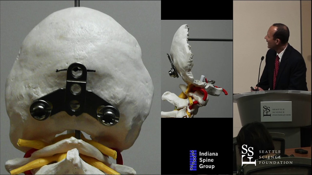 Cranio-Cervical: When and How? - Rick C. Sasso, MD - YouTube