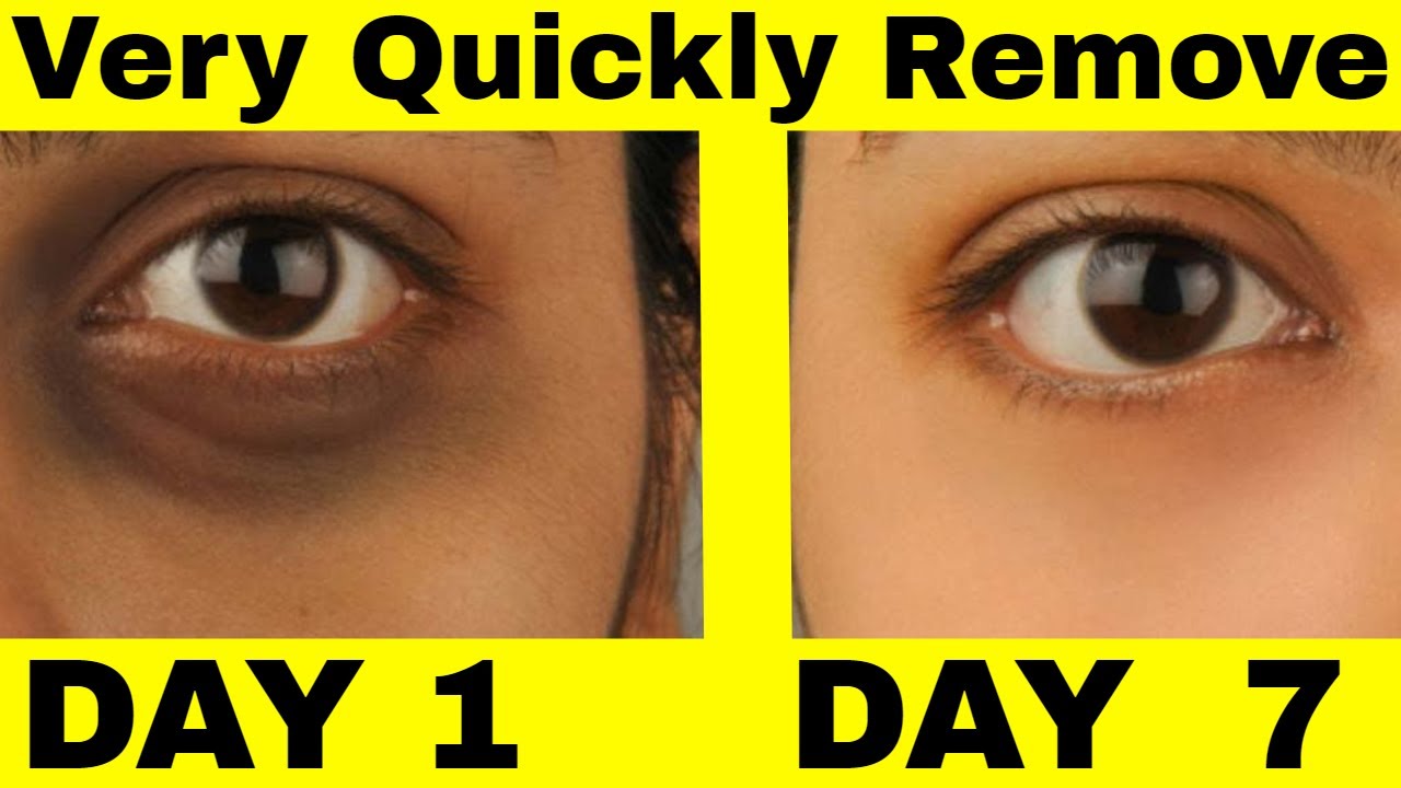 How To Remove Dark Circles 366 How To Remove Dark Circle OVERNIGHT At HOME Remedy 20 2018 how-to-remove-dark-circles-366-how-to-remove-dark-circle-overnight-at-home-remedy-20-2018