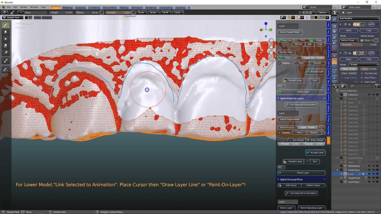 B4D Splint and Guide- Gingivectomy - YouTube