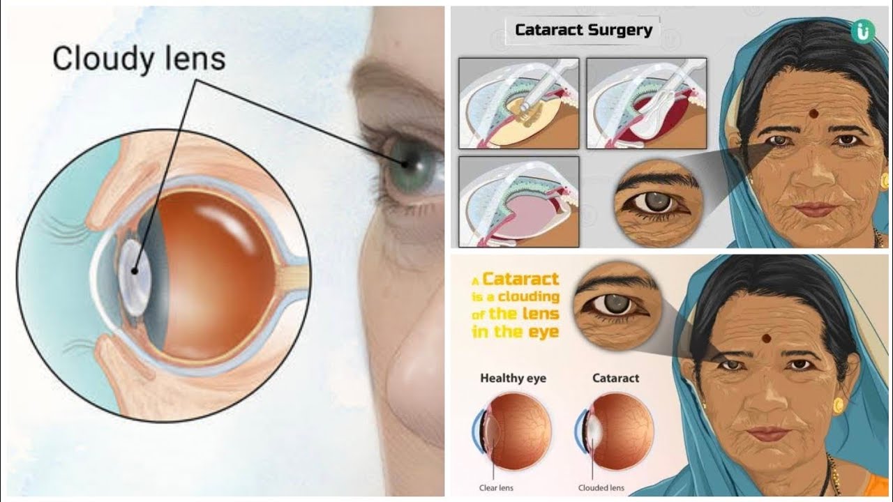 Cataract: Definition, Causes, Risk factors, Symptoms, Diagnosis and ...