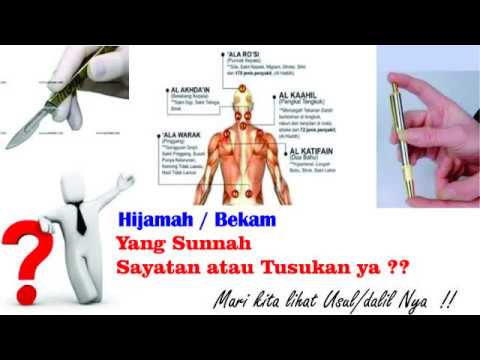 Bekam dengan Sayatan sesuai Sunnah - YouTube