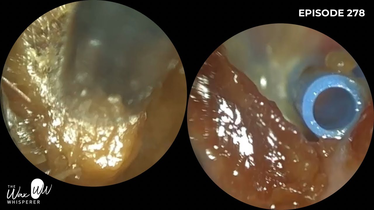 278 - Ear Wax Removal in a patient with a T-Tube due to Chronic ...