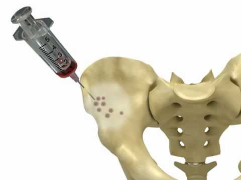 Bone marrow aspiration for progenitor cell harvesting - YouTube