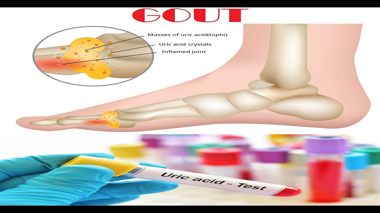 Pathogenesis of Gout - YouTube