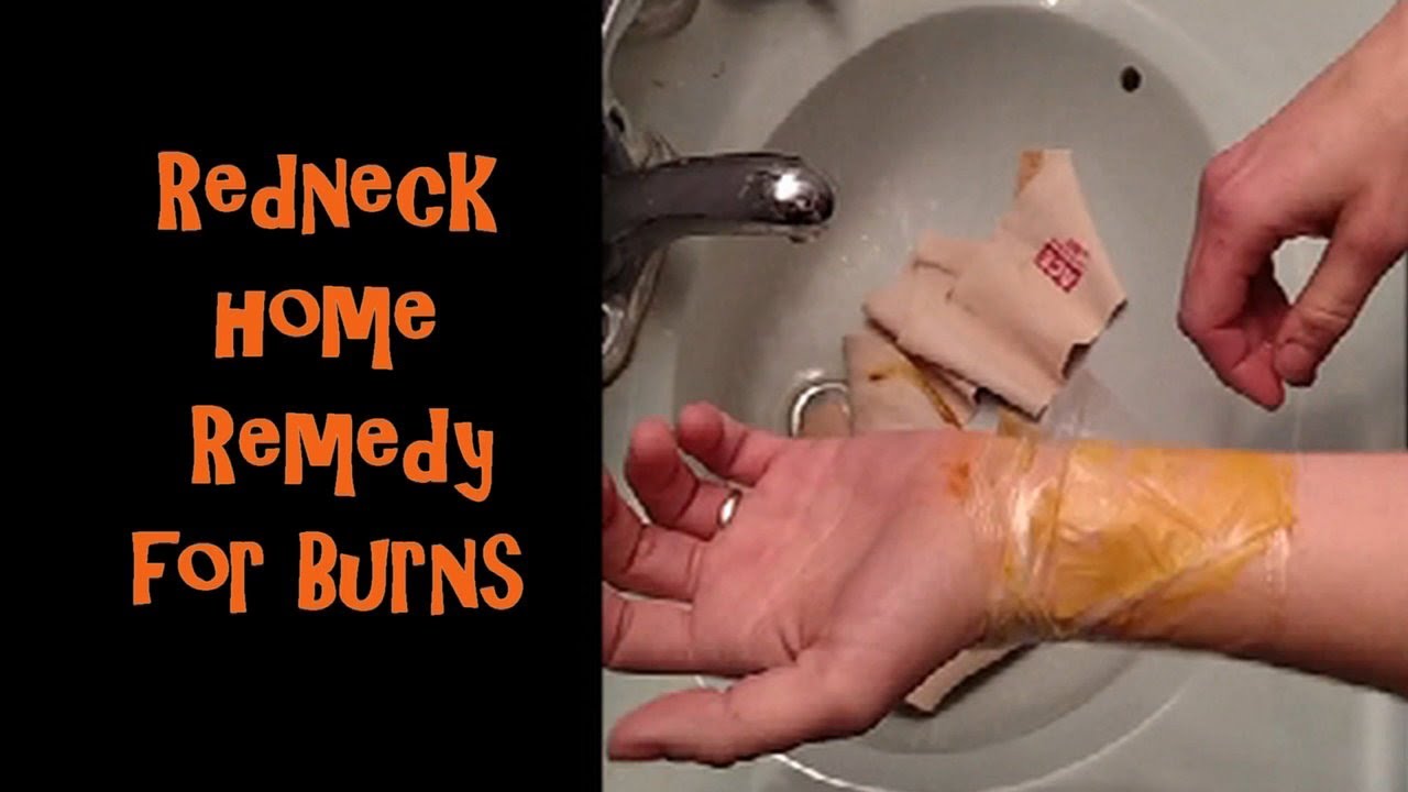 Home Remedy for Burns - How to Treat Minor Burns Practical Redneck Wisdom🍃 - YouTube