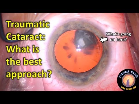 The approach to a Traumatic Cataract from a bungee cord injury to the ...