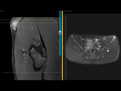 Rare cause of hip pain from iliac apophysitis - YouTube