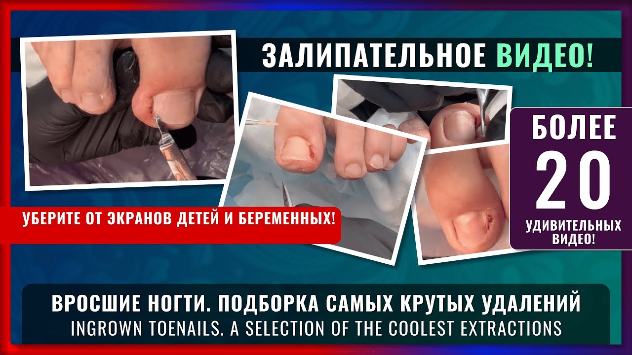 Вросшие ногти / Подборка самых жестких удалений / Ingrown toenails / Podolog Eva - YouTube