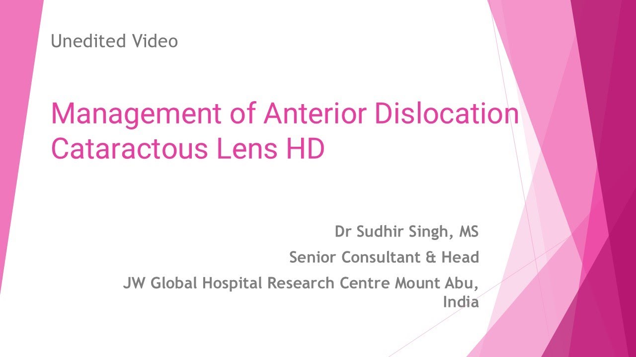 Management of Anterior Dislocation Cataractous Lens HD(unedited) - YouTube