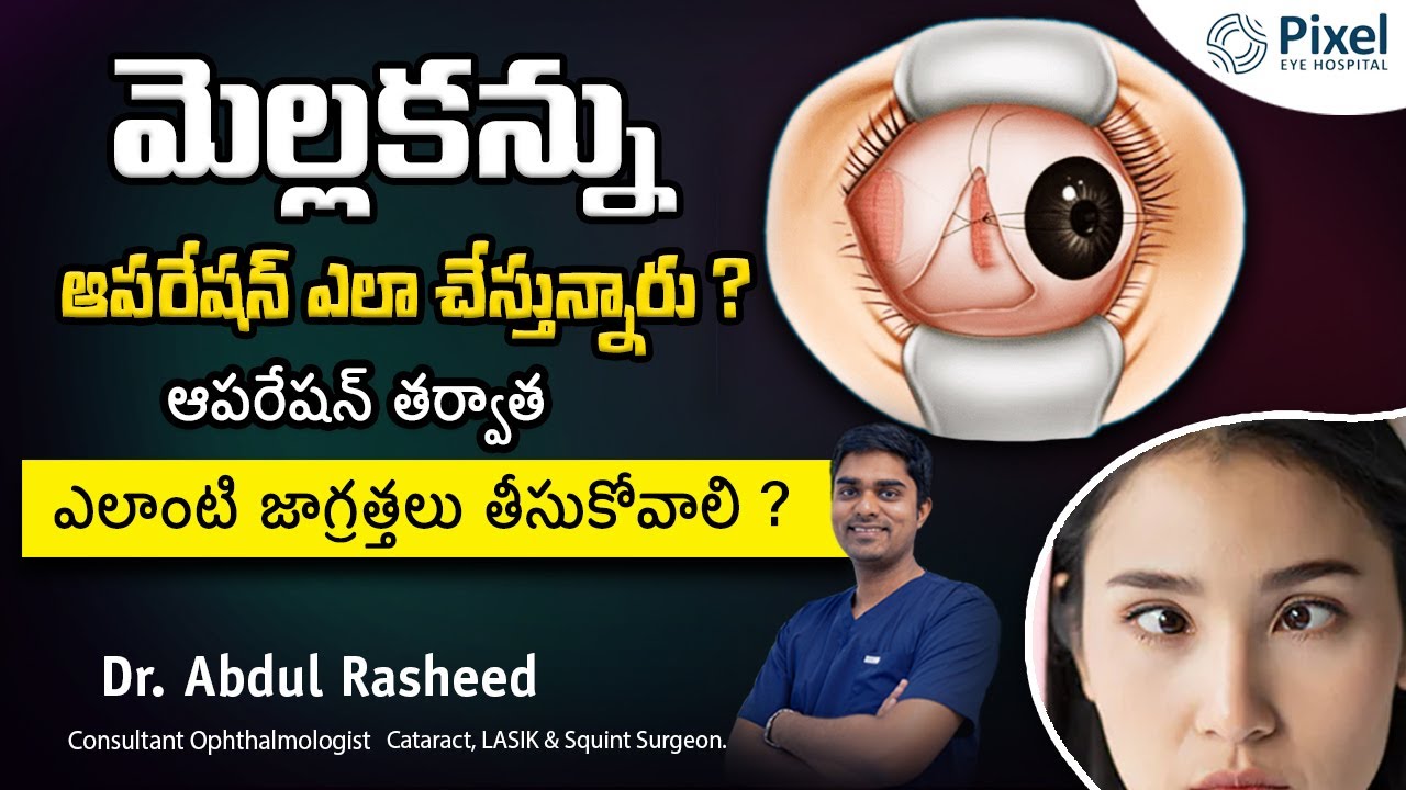 Squint surgery | Precautions after squint surgery | Mella kannu operation | Health| Dr Abdul ...